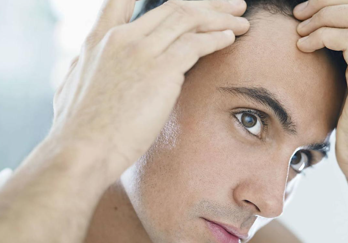 Alopecia: El motivo por el que se te cae el pelo, cinco señales de que te estás quedando calvo y ...